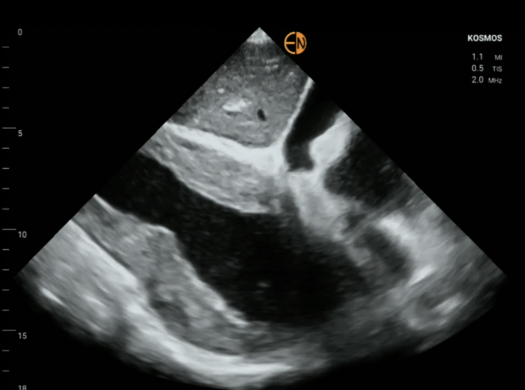 Using Ultrasound to Identify ARVC Criteria in a Patient | EchoNous