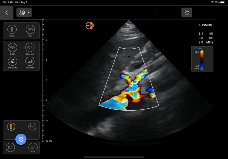 Kosmos AI Ultrasound - EchoNous