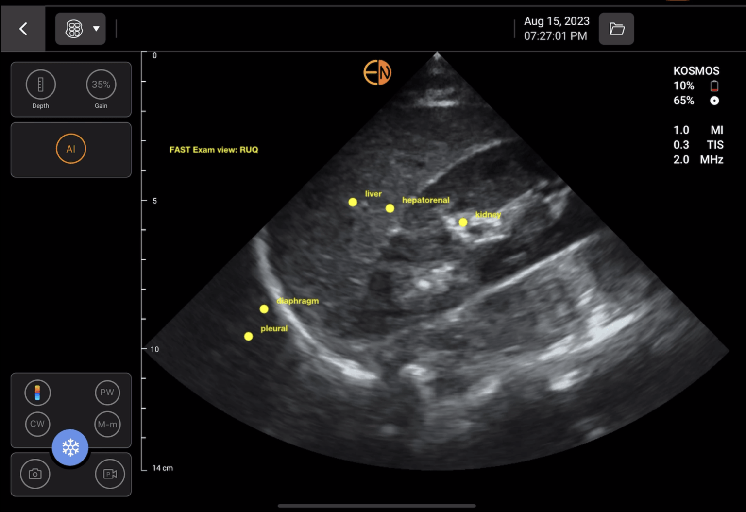 Kosmos AI Ultrasound - EchoNous Kosmos AI Ultrasound - EchoNous