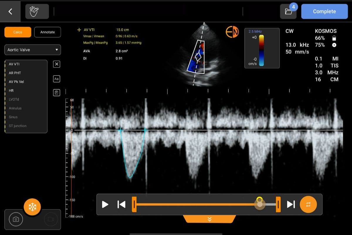POCUS in Cardiology | EchoNous