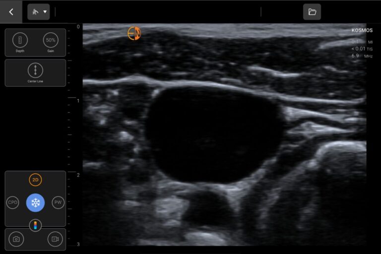 Vascular Access Ultrasound - EchoNous
