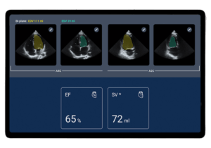 Kosmos Portable Ultrasound - EchoNous