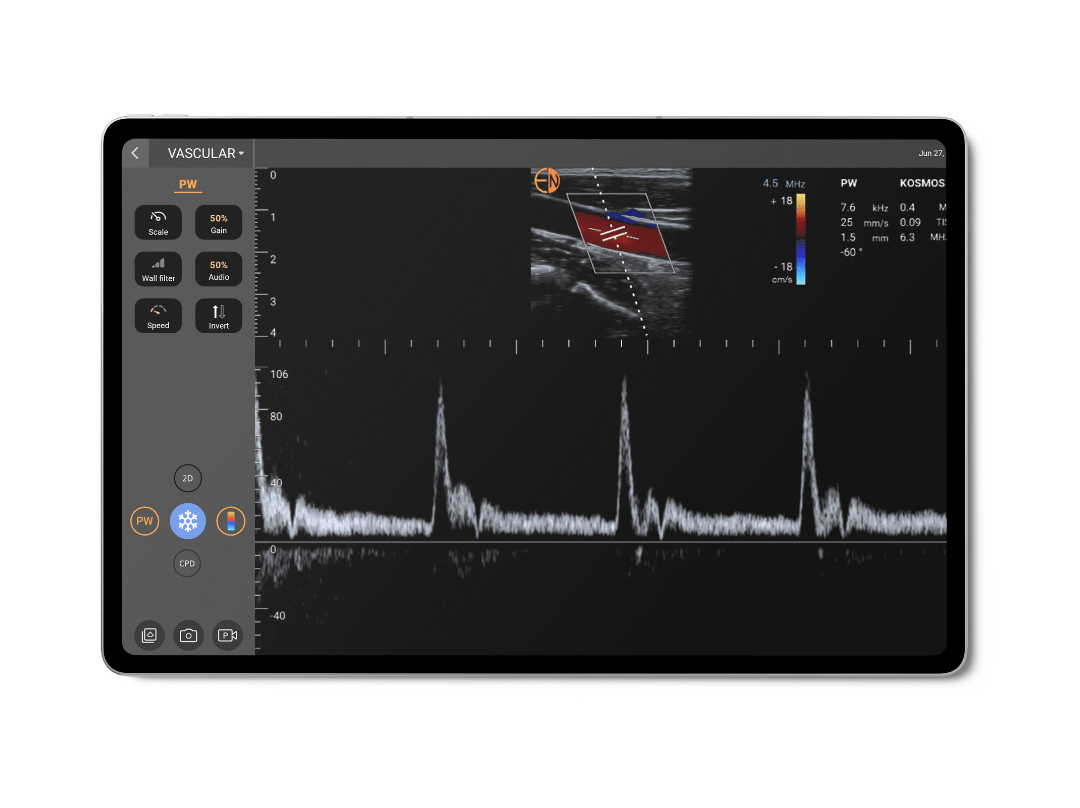 Kosmos AI-driven POCUS device