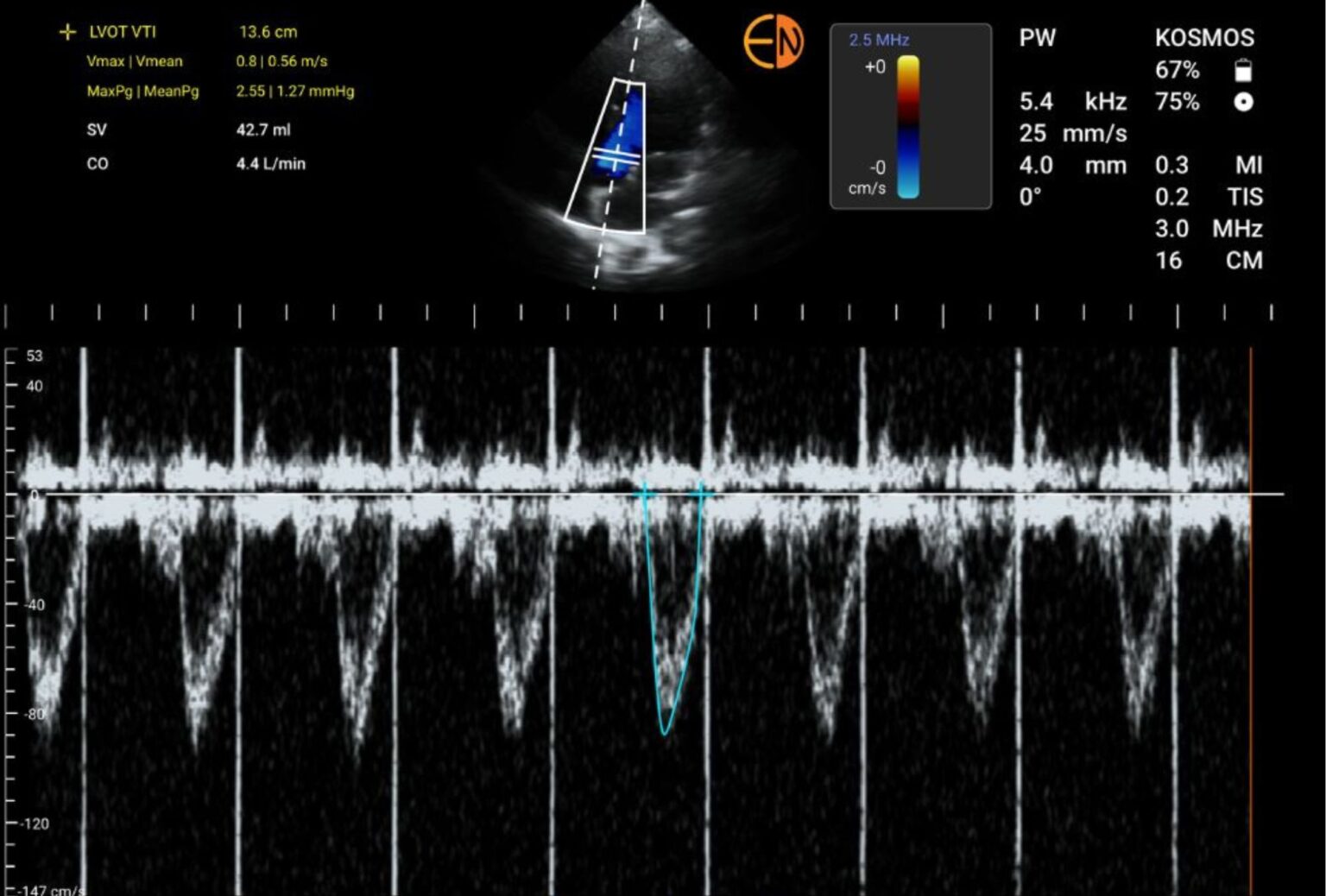 Kosmos AI-powered POCUS in Japan
