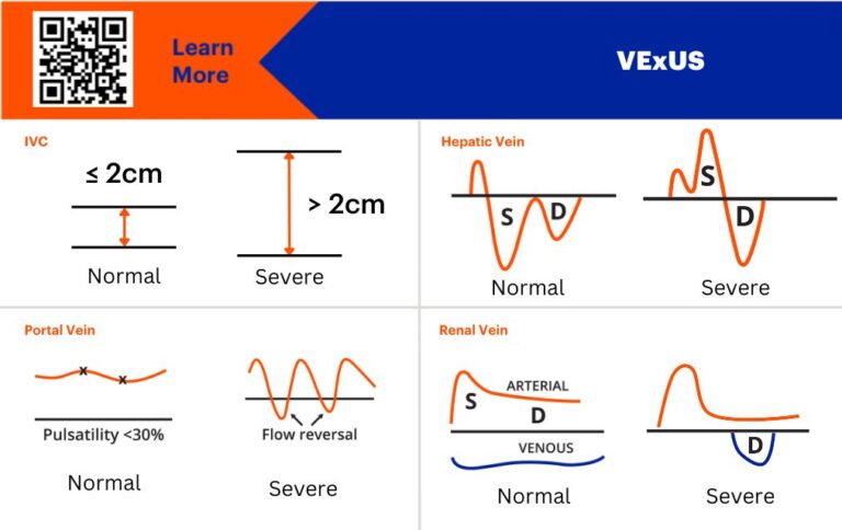 VExUS | Kosmos by EchoNous