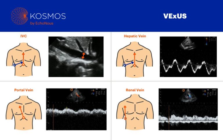 VExUS | Kosmos by EchoNous